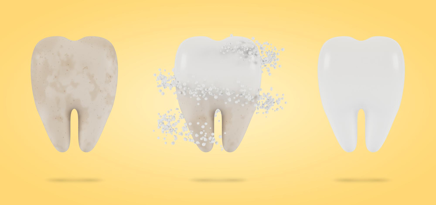 Teeth Whitening